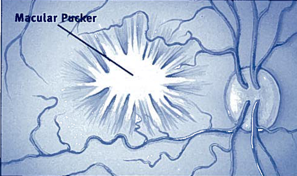 Macular Pucker Retina Specialists Eye Surgery Retina Associates Cameron Javid Md
